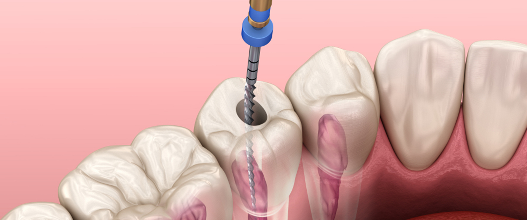 5 Best Endo Rotary Files - Dentalkart