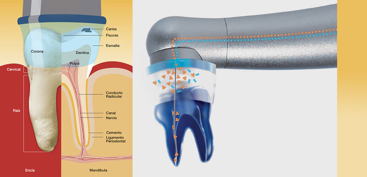 HealOzone Explained: The Future of Pain-Free Dentistry is Here - Dentalkart
