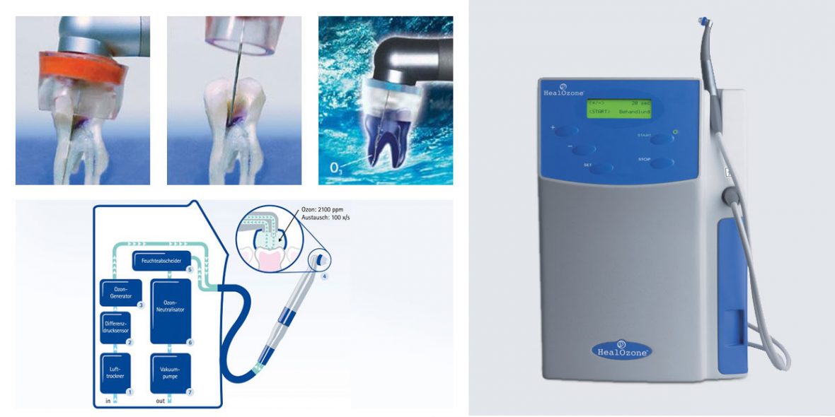 HealOzone Explained: The Future of Pain-Free Dentistry is Here - Dentalkart