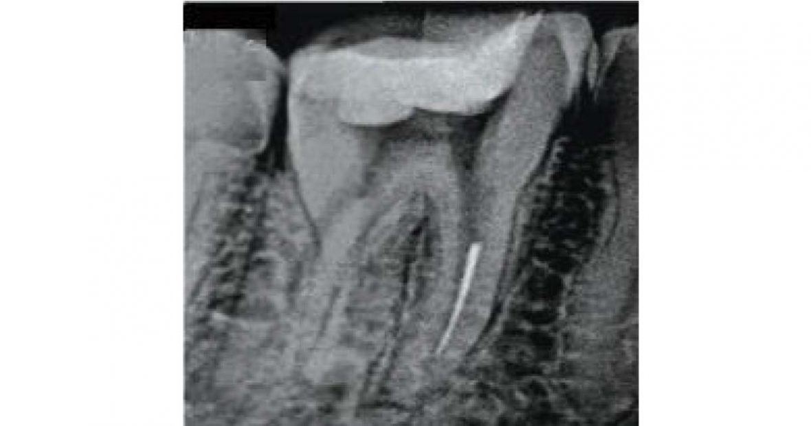 Common Errors during Root Canal Treatment - Dentalkart