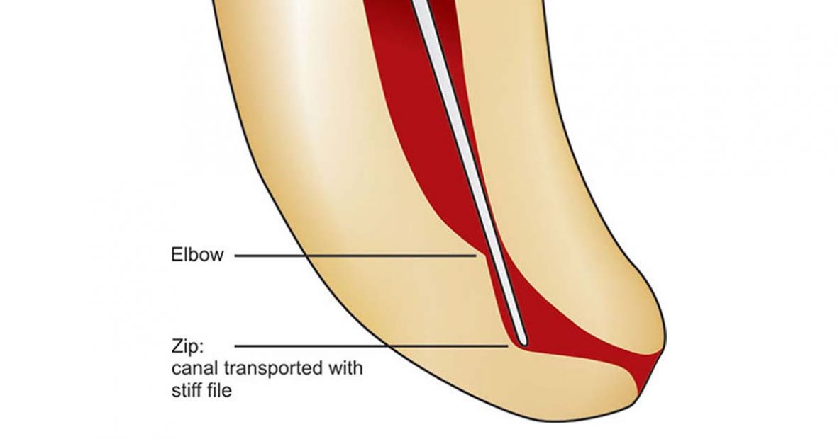 Common Errors during Root Canal Treatment - Dentalkart