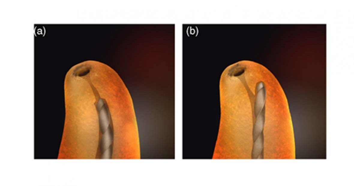 Common Errors during Root Canal Treatment - Dentalkart