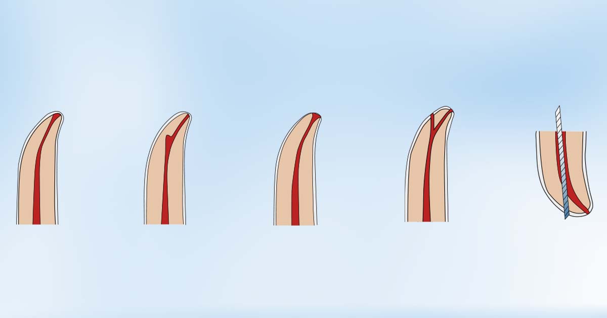 Common Errors during Root Canal Treatment - Dentalkart