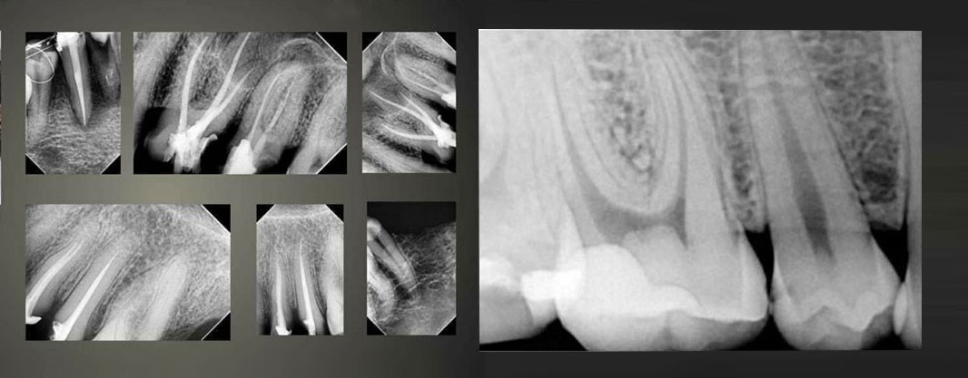 Woodpecker i-Sensor RVG: A New Era in Dental Radiography? - Dentalkart