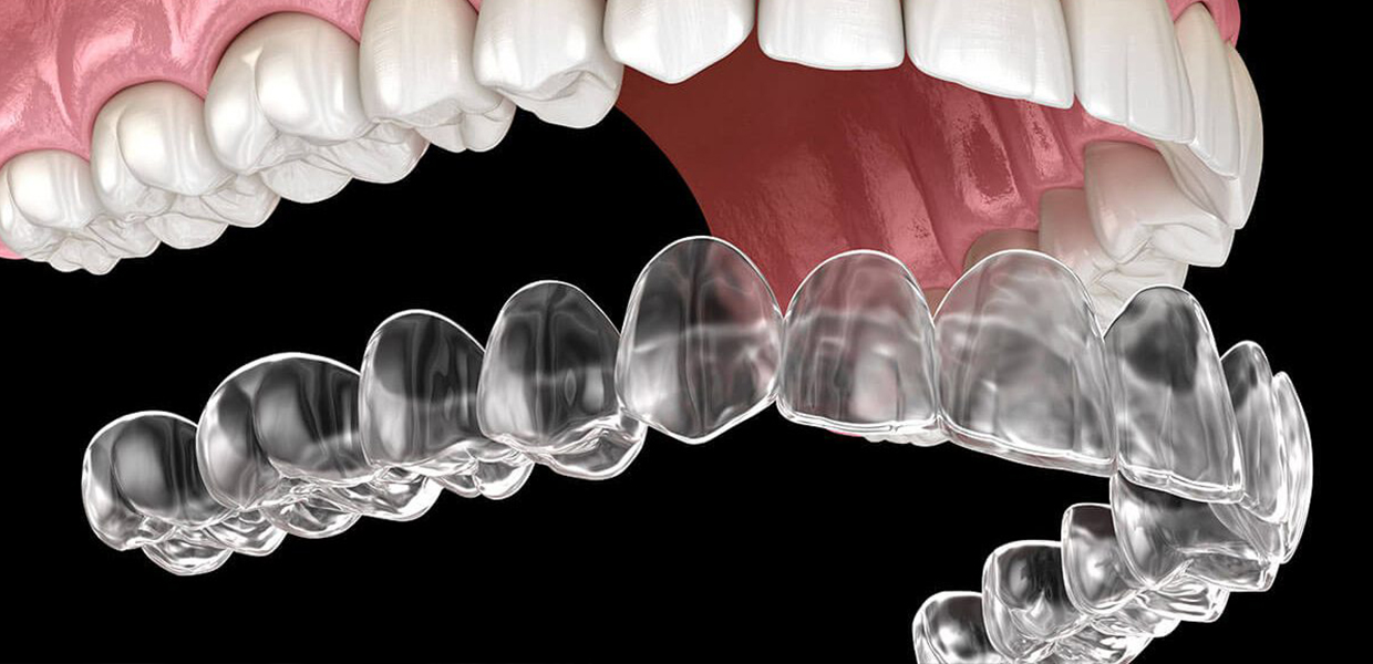 Everything You Need to Know About Clear Aligners - Dentalkart
