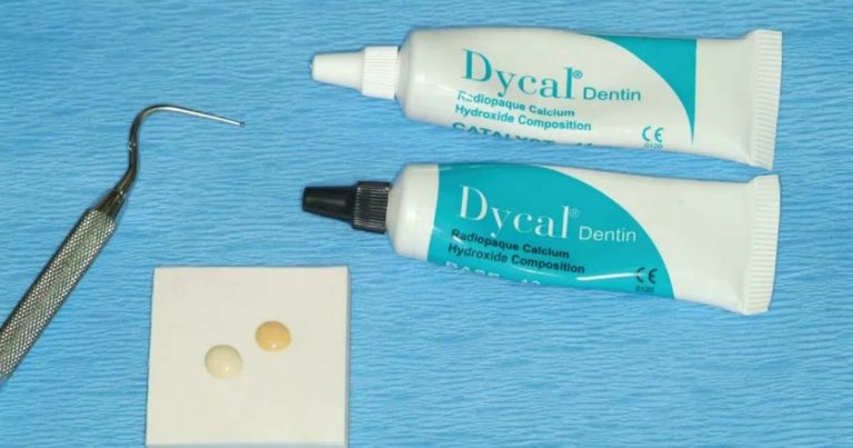 Dental Cements: Types, Uses and Top Picks for Restorations