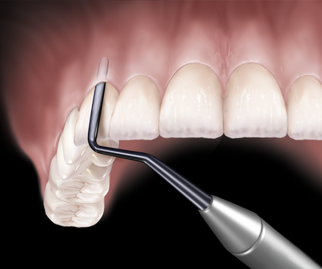 Atraumatic Extraction Procedure: A Comprehensive Guide to Minimally ...