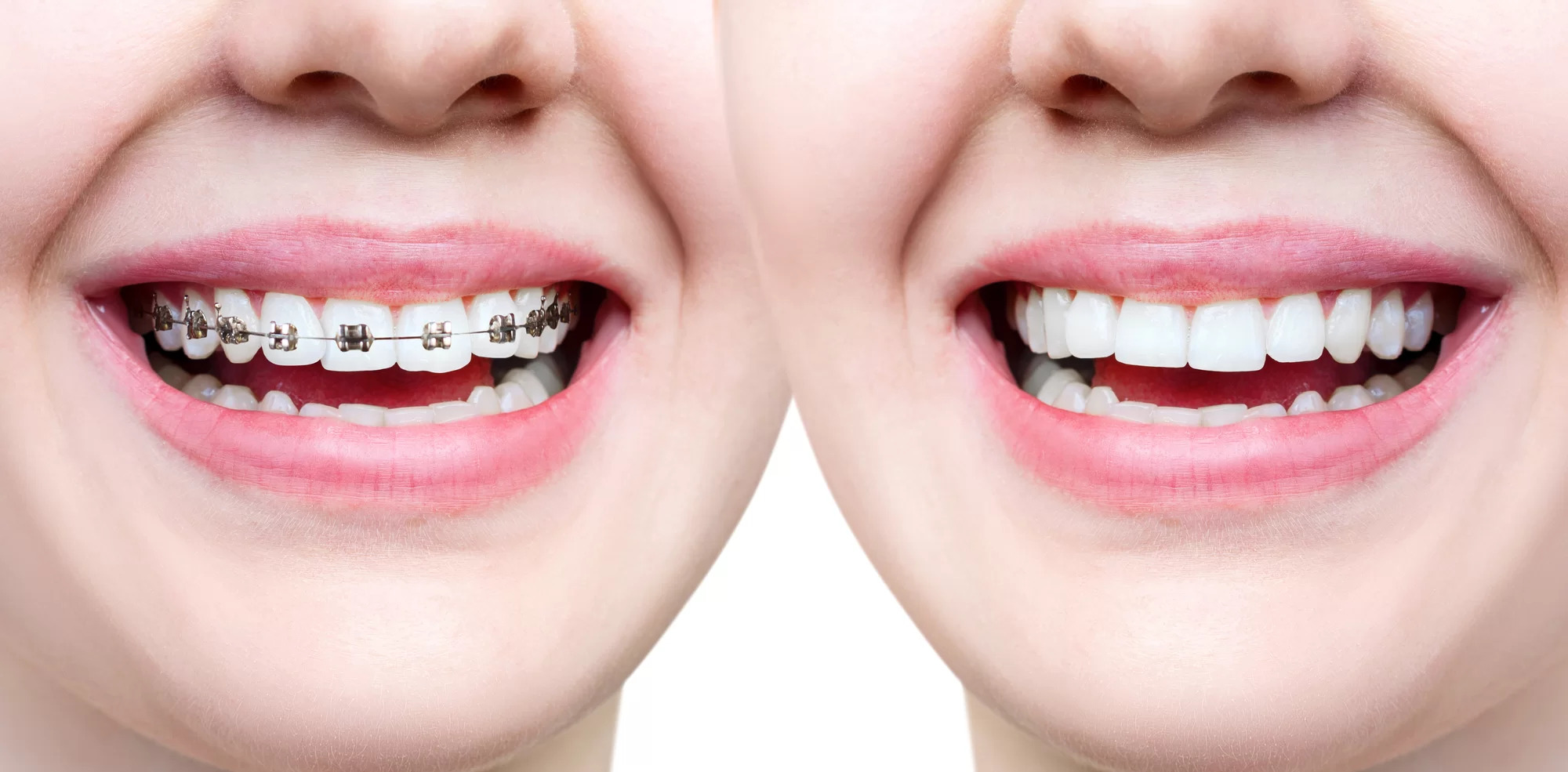 Braces vs Clear Aligners: A Comprehensive Comparison for Dental ...