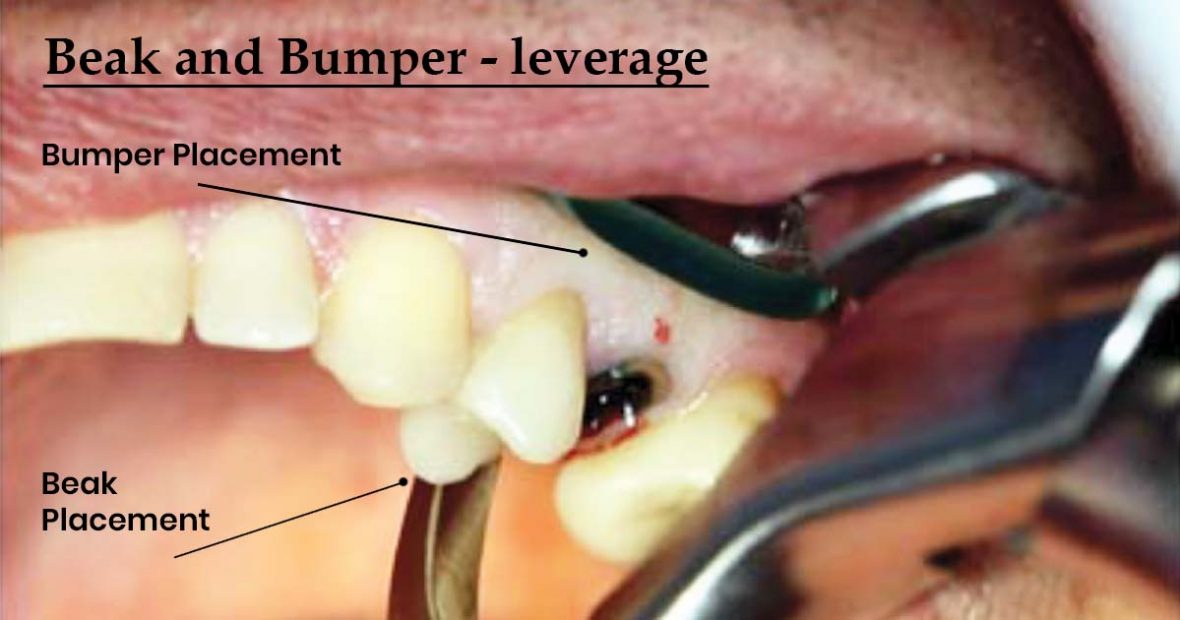 PHYSICS FORCEPS: Best Approach to Atraumatic Extraction - Dentalkart