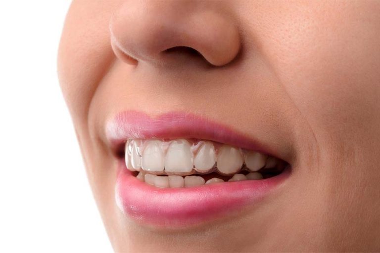 Types of Retainers in Dentistry: Removable Vs Permanent - Dentalkart