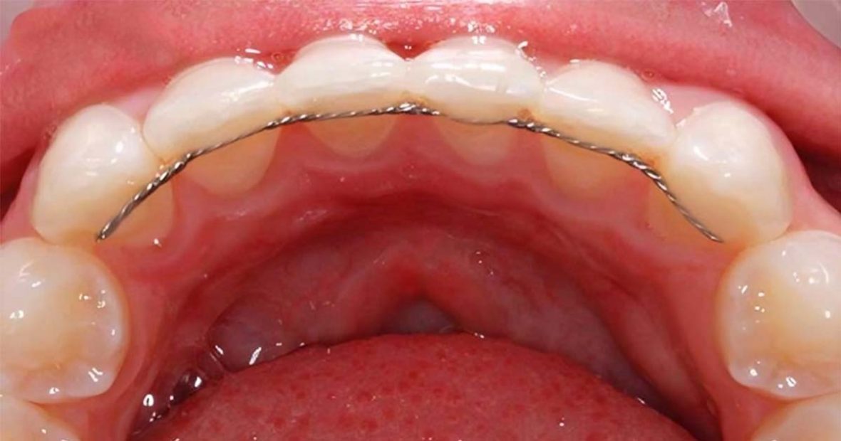 Types of Retainers in Dentistry: Removable Vs Permanent - Dentalkart