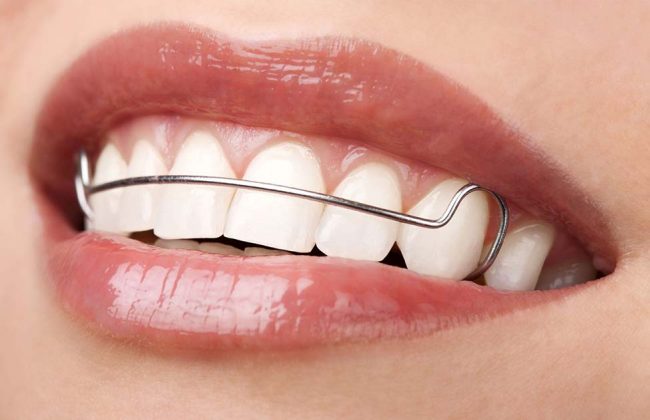 Types of Retainers in Dentistry: Removable Vs Permanent - Dentalkart