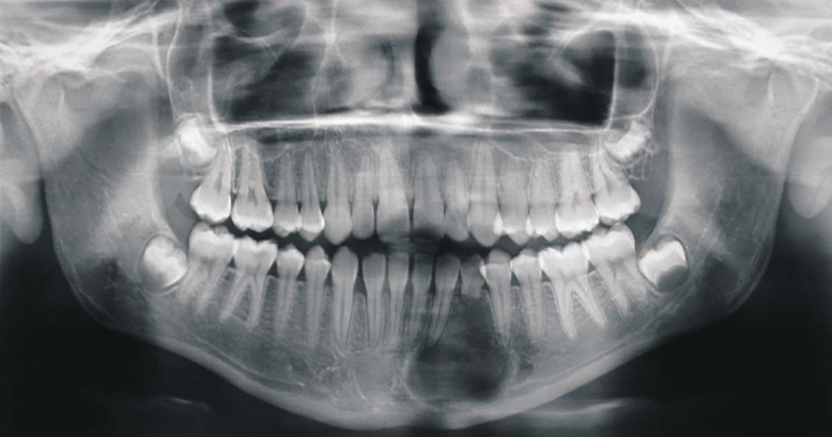 Digital Radiography in Dentistry - Dentalkart