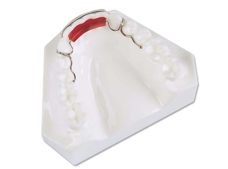 Types of Retainers in Dentistry: Removable Vs Permanent - Dentalkart