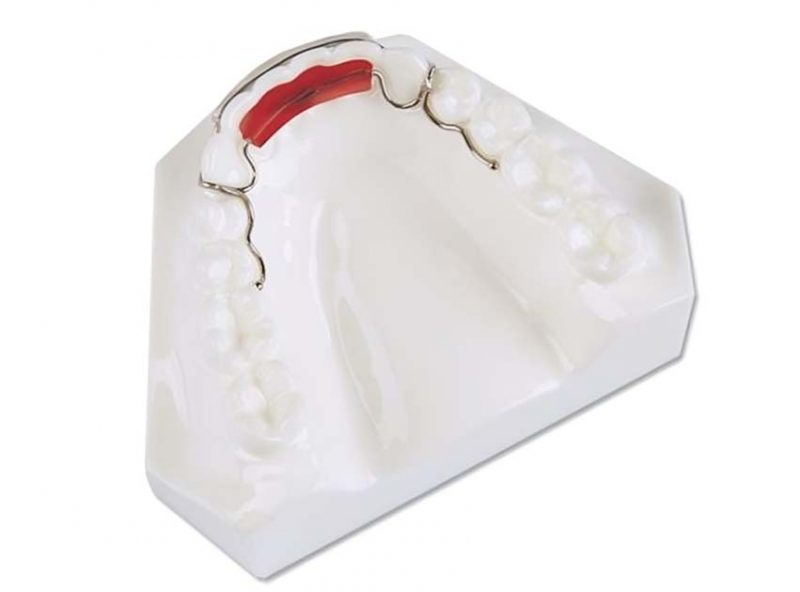 Types of Retainers in Dentistry: Removable Vs Permanent - Dentalkart