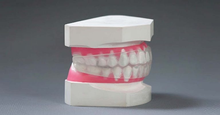 Types of Retainers in Dentistry: Removable Vs Permanent - Dentalkart