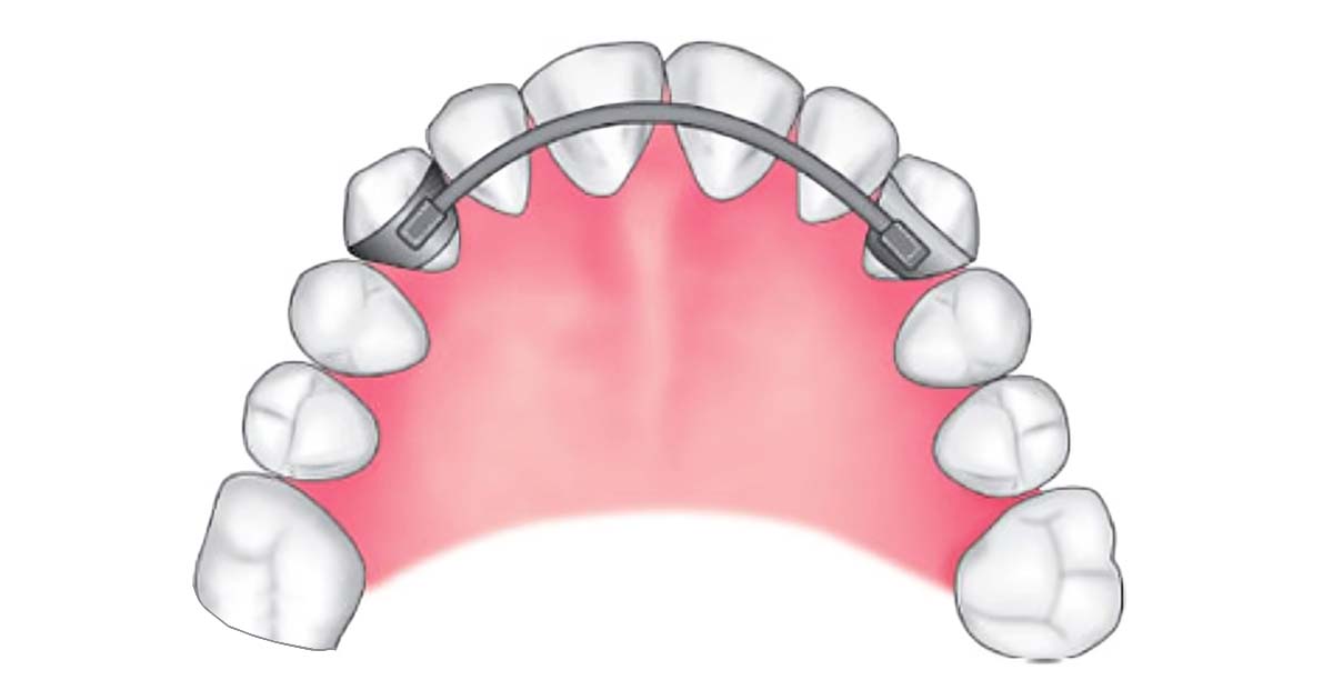 Types of Retainers in Dentistry: Removable Vs Permanent - Dentalkart