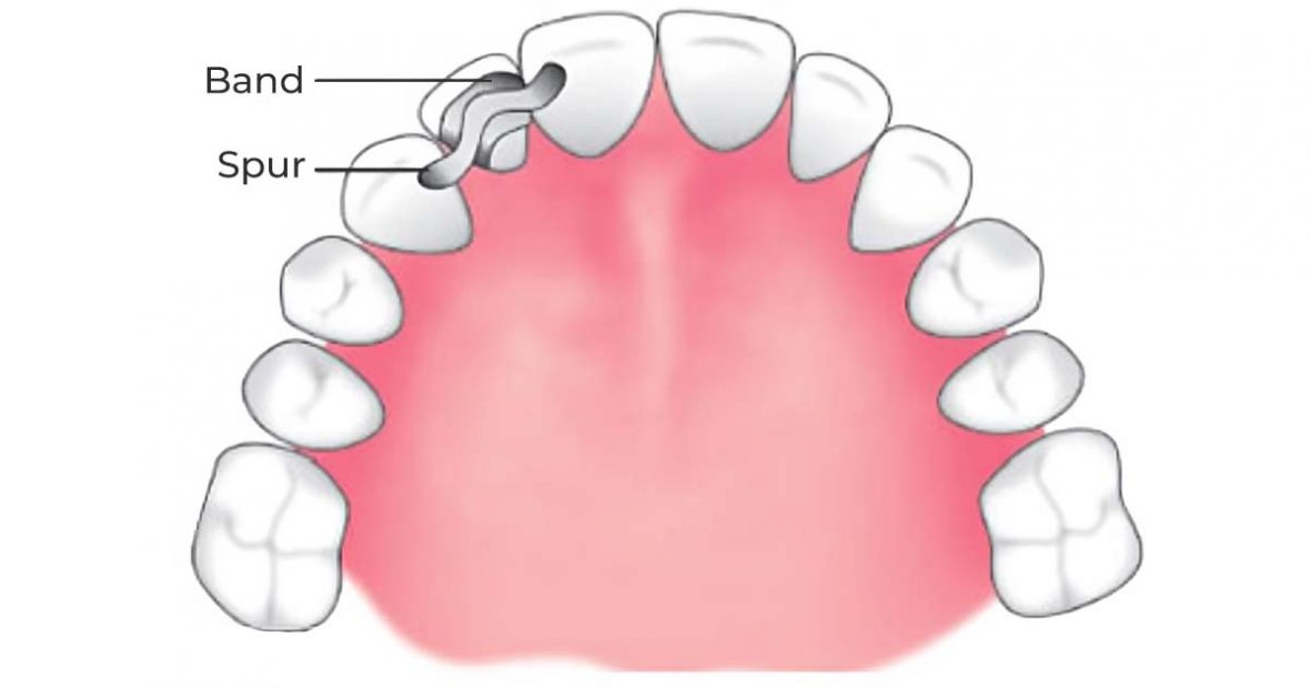 Types of Retainers in Dentistry: Removable Vs Permanent - Dentalkart
