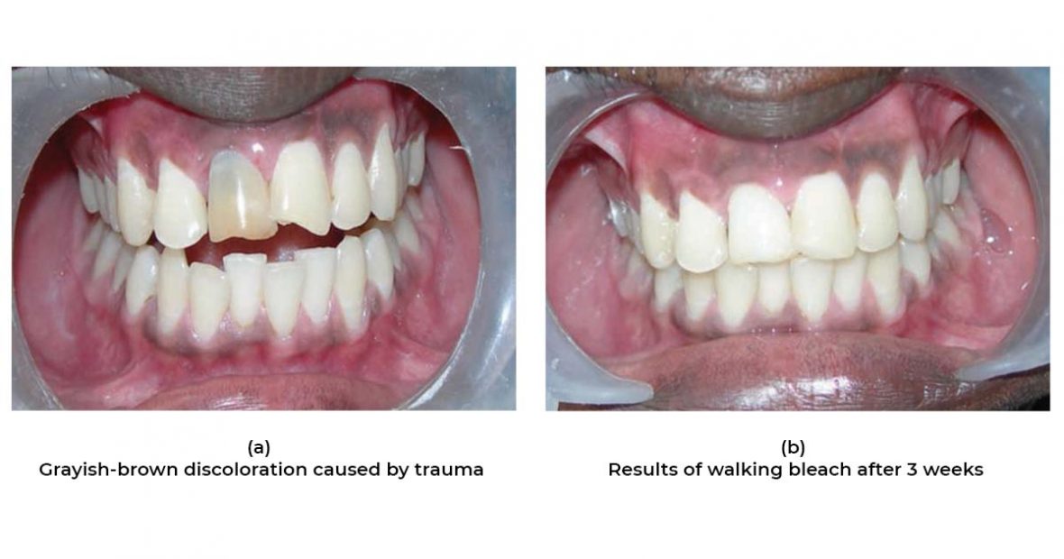 Teeth Whitening : Types, Procedure and Technique - Dentalkart