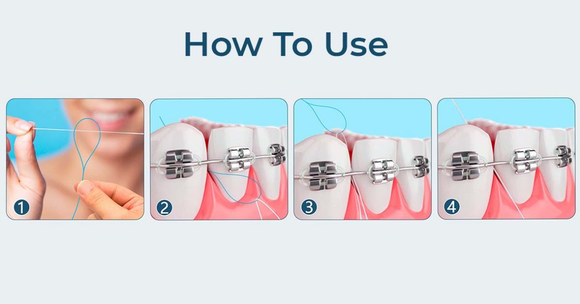 Interdental Cleaning Aids: A Dentist’s Guide to Recommending