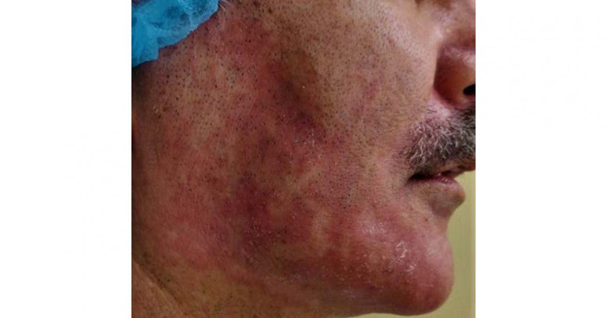 Dental Local Anesthesia: Essential Insights for Every Dentist - Dentalkart