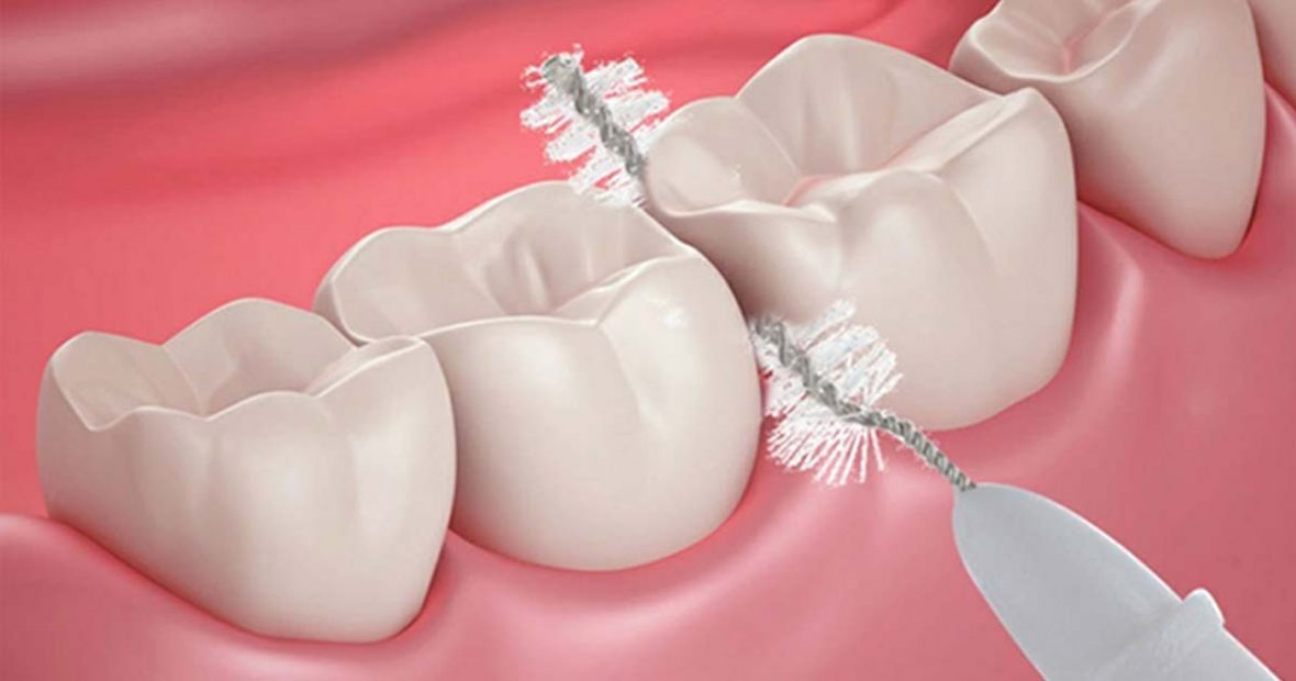 Interdental Cleaning Aids: A Dentist’s Guide to Recommending