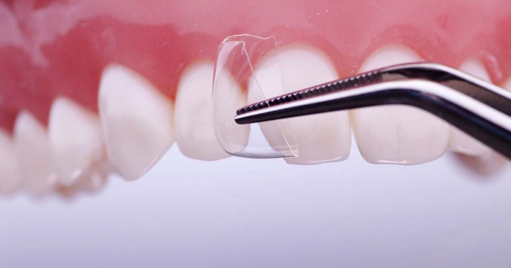 Types of Dental Matrix Systems | Role of Matrix in Dentistry
