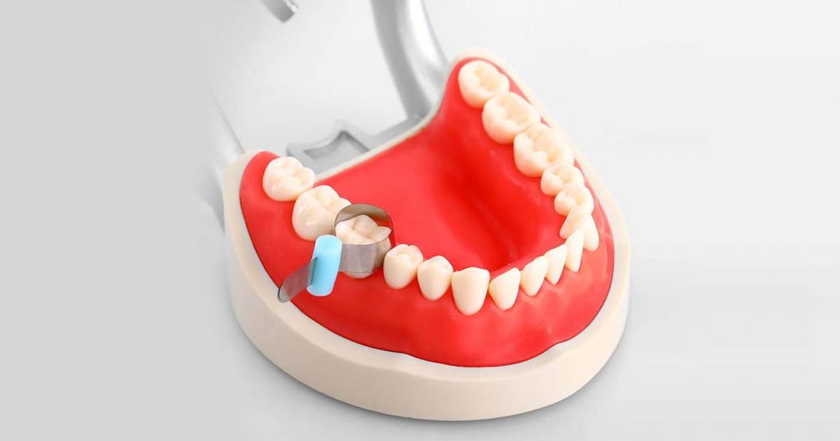 Types of Dental Matrix Systems | Role of Matrix in Dentistry