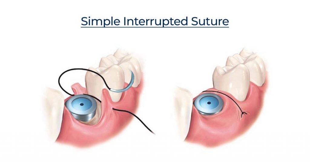 Suturing Techniques & Choosing the Right Dental Materials