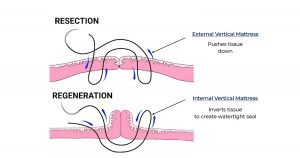Suturing Techniques & Choosing the Right Dental Materials