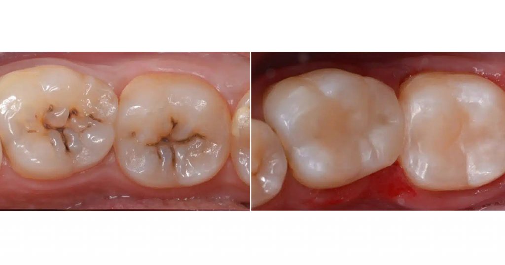 GIC vs Composite: Tooth-Colored Restorations