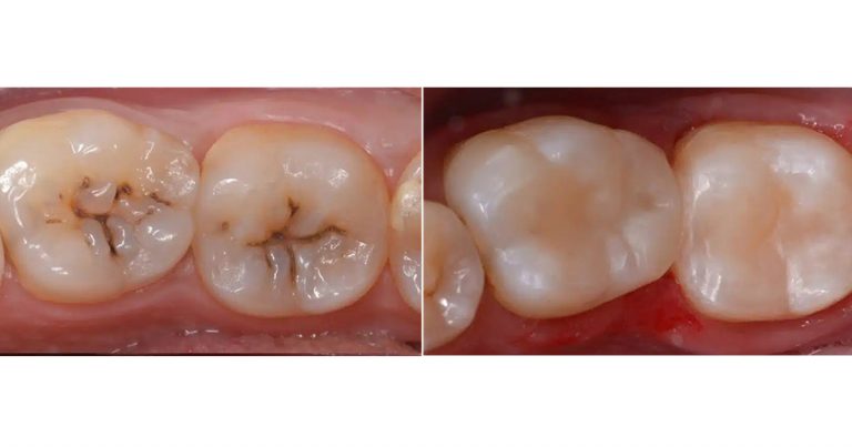 GIC vs Composite: Tooth-Colored Restorations