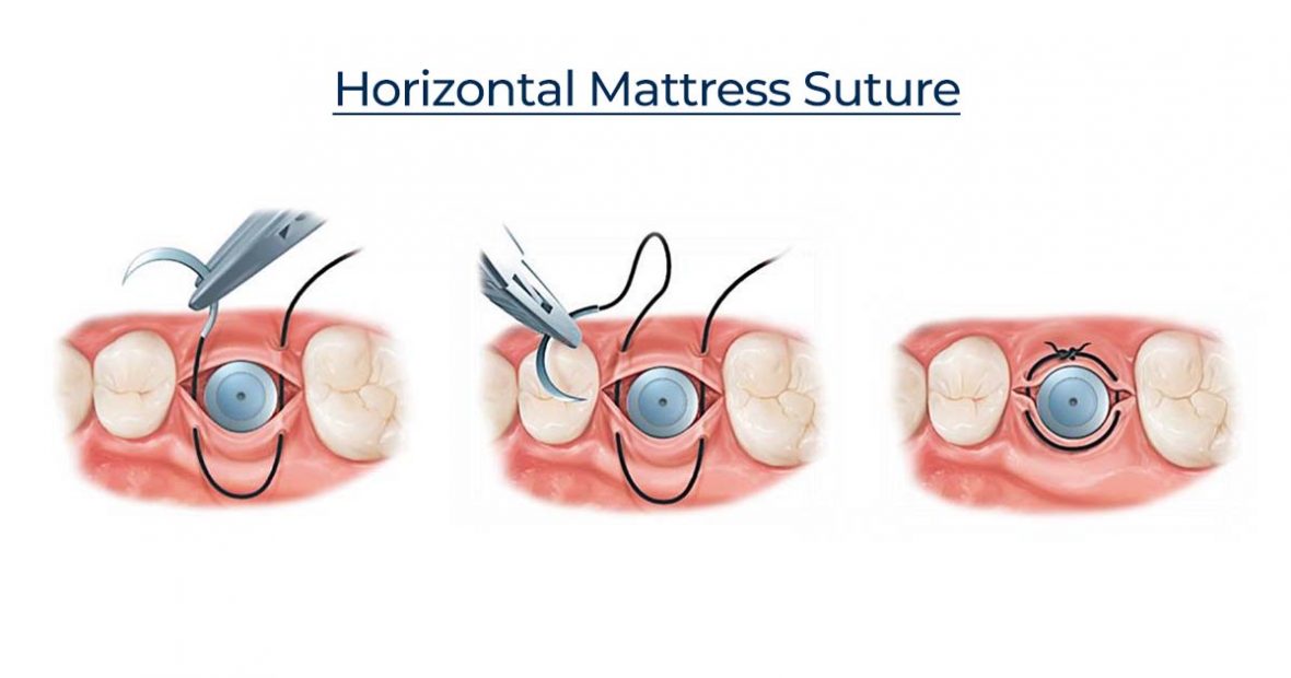 Suturing Techniques & Choosing the Right Dental Materials