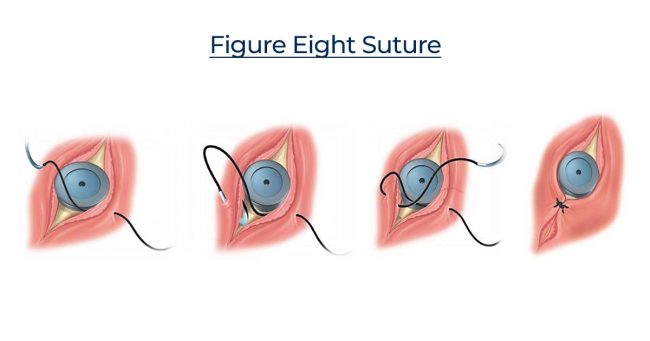 Suturing Techniques & Choosing the Right Dental Materials