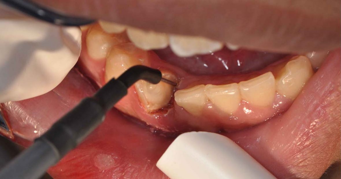 Electrosurgery in Dentistry: Techniques, Benefits, and Best Practices ...