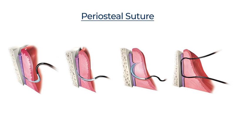 Suturing Techniques & Choosing the Right Dental Materials