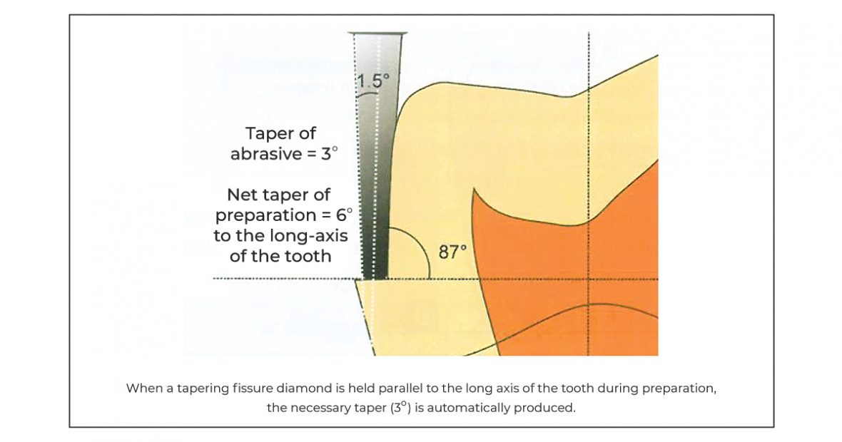 Tooth Preparation: A Student's Guide for Full Coverage Dental Crown ...