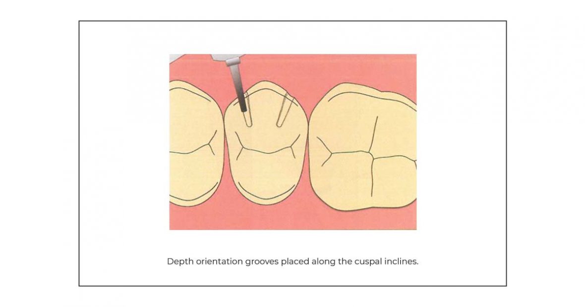 Tooth Preparation: A Student's Guide for Full Coverage Dental Crown ...