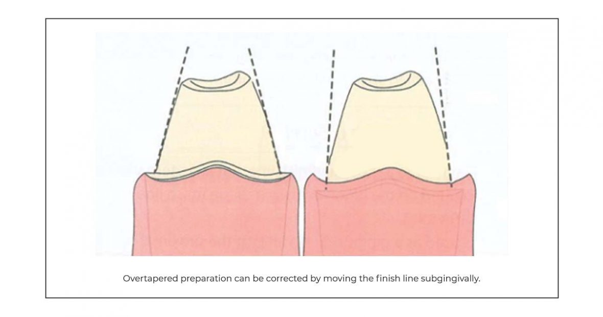 Tooth Preparation: A Student's Guide for Full Coverage Dental Crown ...