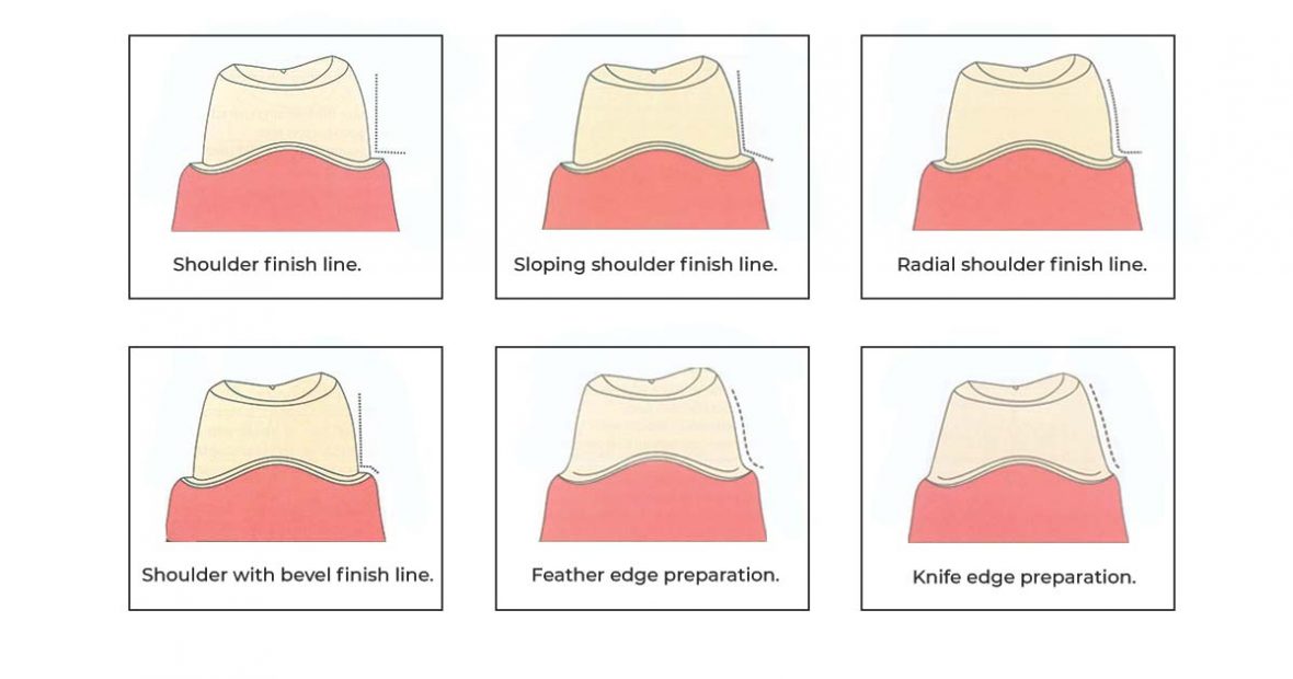 Tooth Preparation: A Student's Guide for Full Coverage Dental Crown ...
