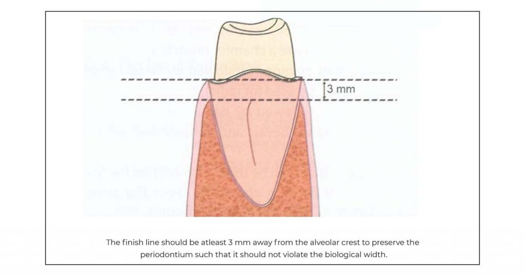 Tooth Preparation: A Student's Guide for Full Coverage Dental Crown ...