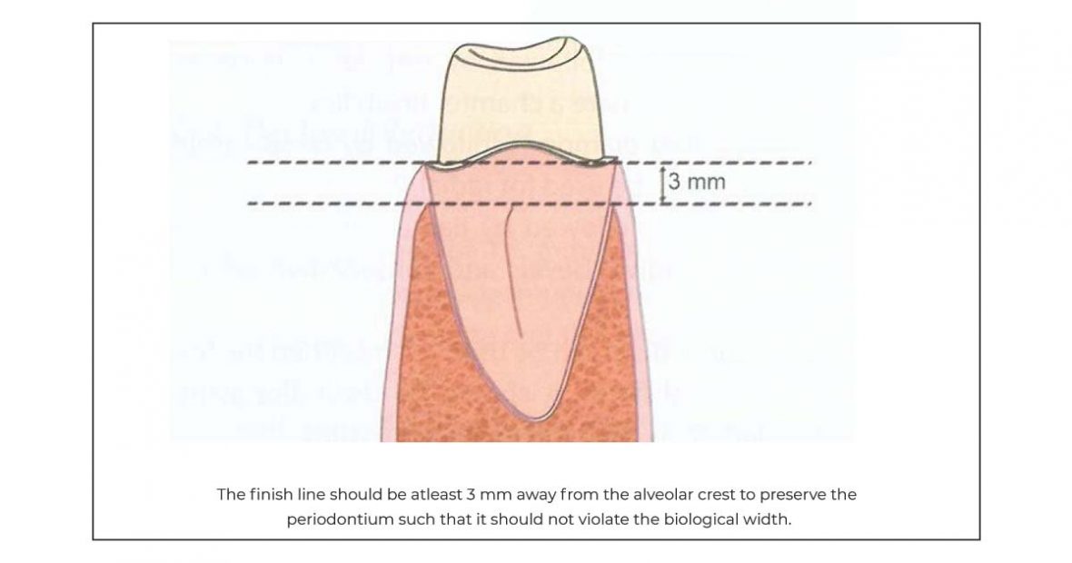 Tooth Preparation: A Student's Guide for Full Coverage Dental Crown ...