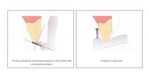 Tooth Preparation: A Student's Guide for Full Coverage Dental Crown ...