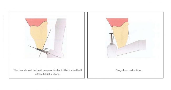 Tooth Preparation: A Student's Guide for Full Coverage Dental Crown ...