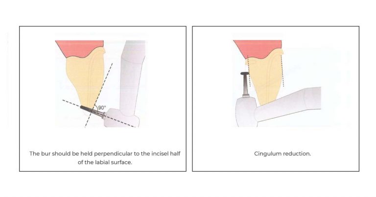 Tooth Preparation: A Student's Guide for Full Coverage Dental Crown ...