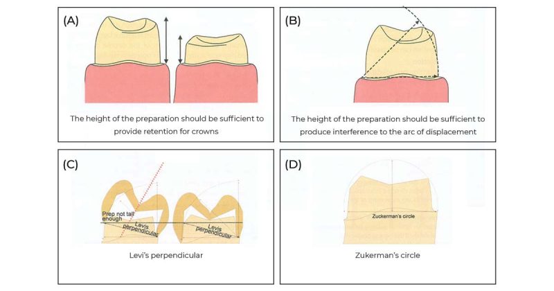 Tooth Preparation: A Student's Guide for Full Coverage Dental Crown ...