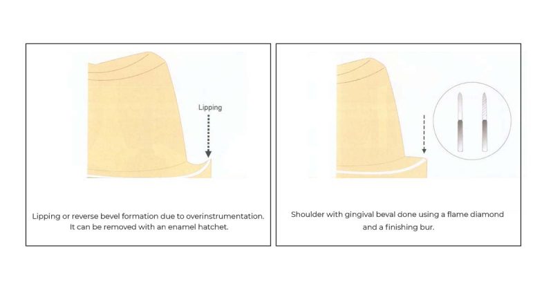 Tooth Preparation: A Student's Guide for Full Coverage Dental Crown ...