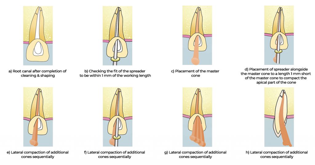 Effective Obturation Techniques for Successful Root Canal Treatments - Dentalkart