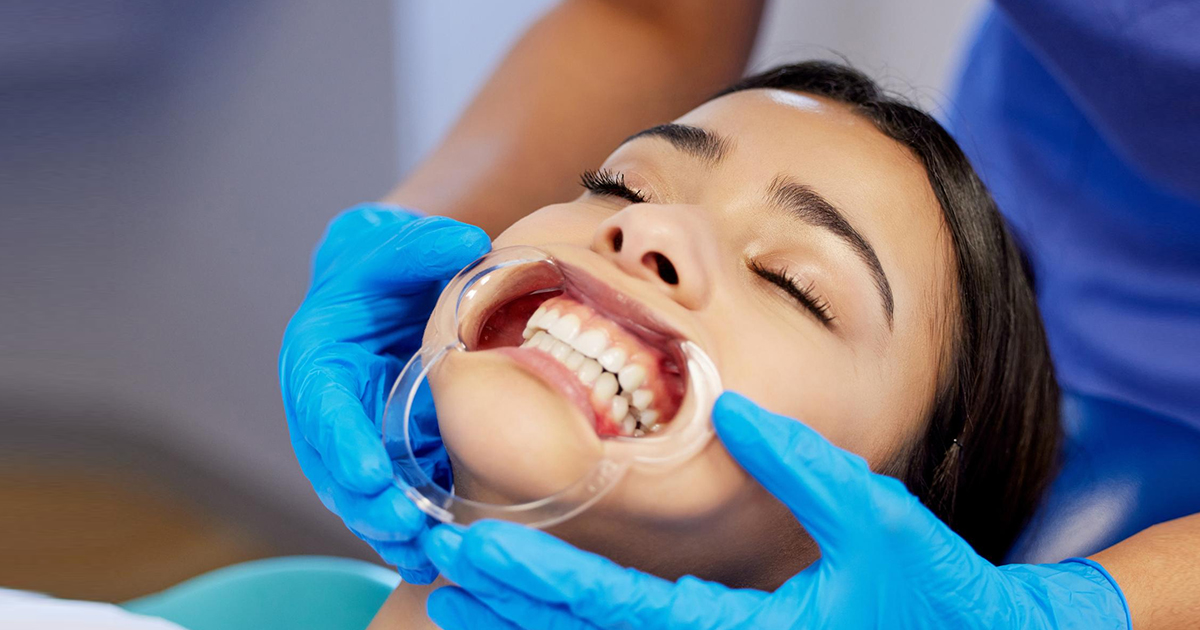 Cheek Retractors: Types, Benefits, and Common Mistakes to Avoid in Dental Practice - Dentalkart