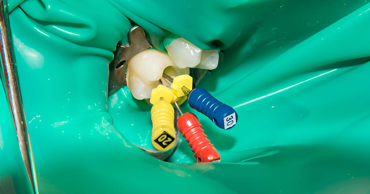 Difference Between K-File and H-File in Dentistry Explained